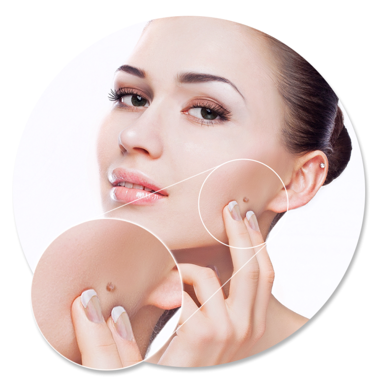 Laser Moles & Warts Removal Treatment